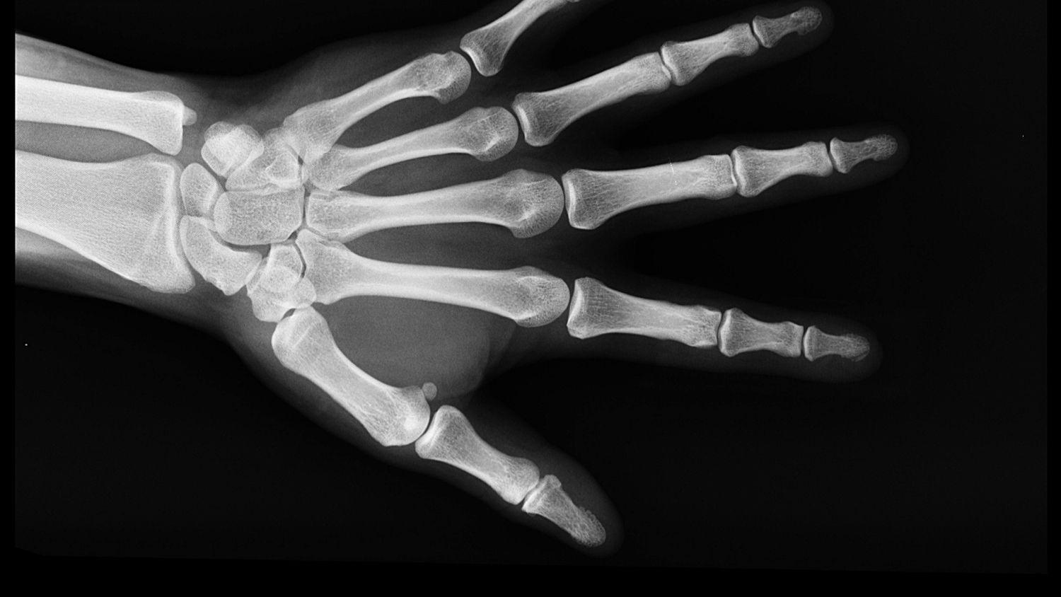 Osteoporoosi on hiljainen ja etenevä kansansairaus, josta ei kerrota ...
